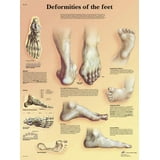 Anatomical chart: deformities of the feet, laminated - Walmart.com
