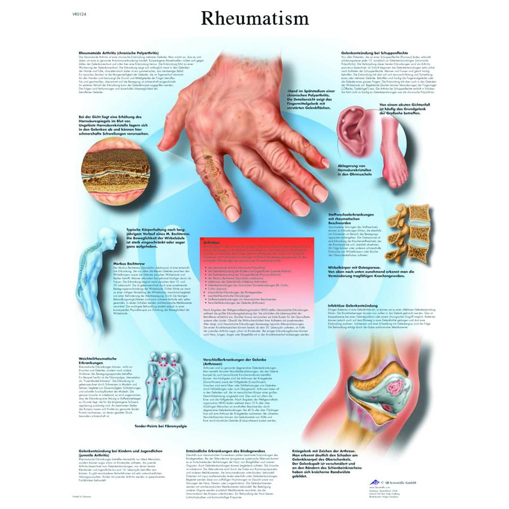 3B Anatomical Rheumatic Diseases Wall Chart, Multicolor - Walmart.com