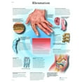 Anatomical chart: rheumatic diseases, paper - Walmart.com