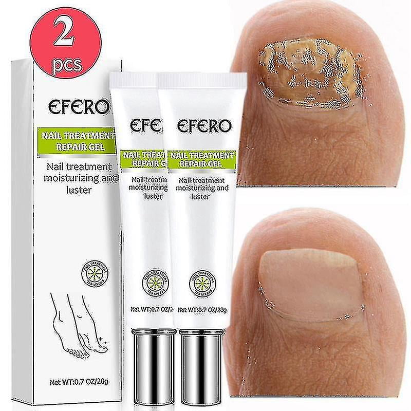 Anti-fungal Nail Gel Fungal Nails Treatment Serum Hand Foot Cream ...