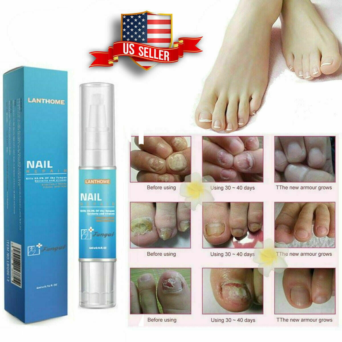 Antibacterial Fungal Nail Treatment Nail Repair Paronychia Treatment ...