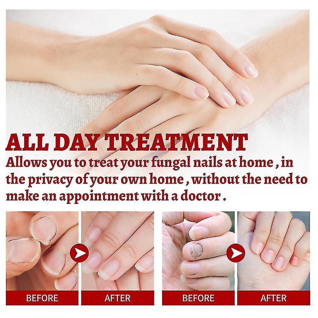 Antifungal Foot Care Tool - Inner Nail Repair Essence For Soothing And ...