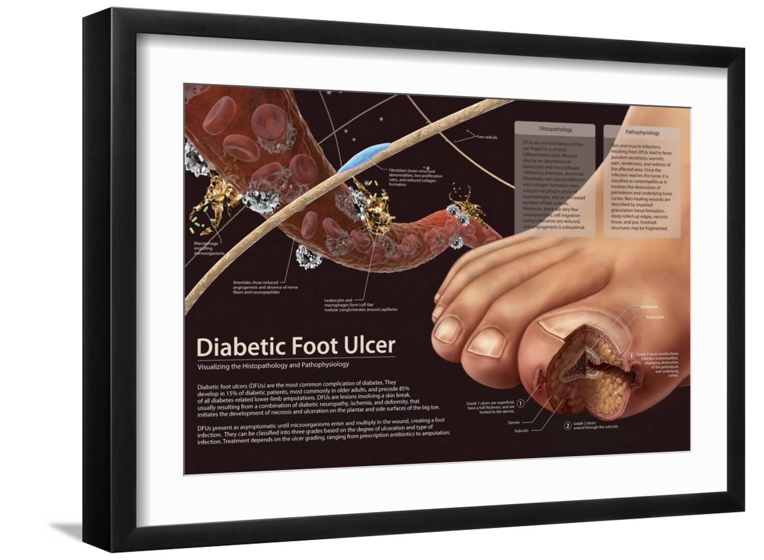 Art.com Histopathology and Pathophysiology of Diabetic Food Ulcers Art ...