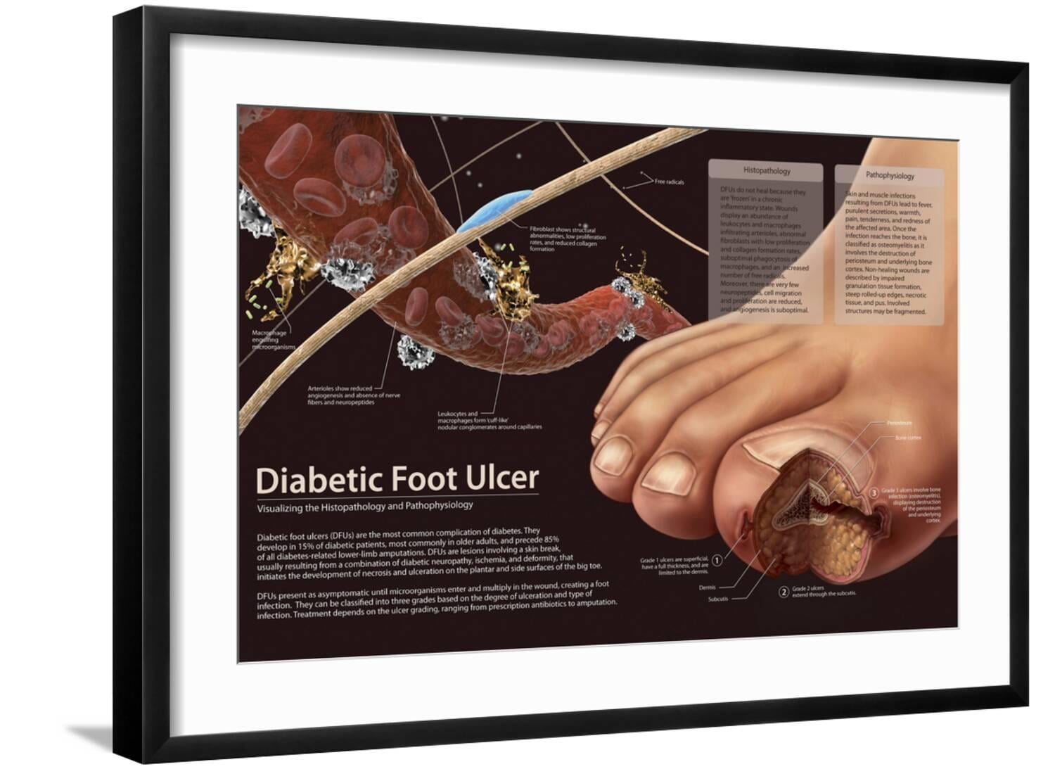 Art.com Histopathology and Pathophysiology of Diabetic Food Ulcers Art ...