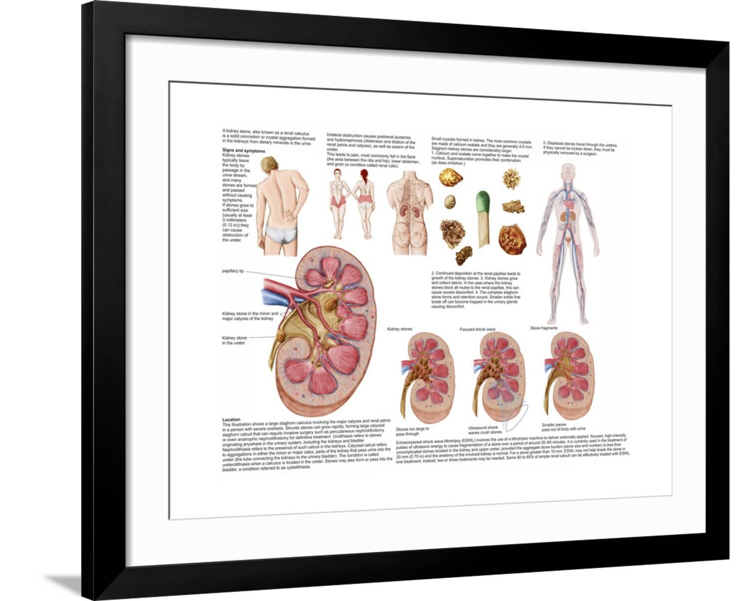 Art.com Medical Chart Showing the Signs and Symptoms of Kidney Stones ...