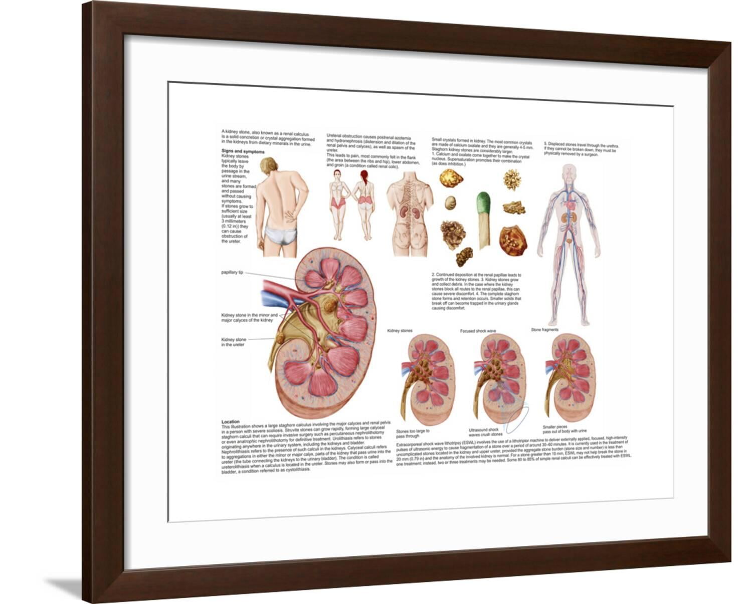 Art.com Medical Chart Showing the Signs and Symptoms of Kidney Stones ...
