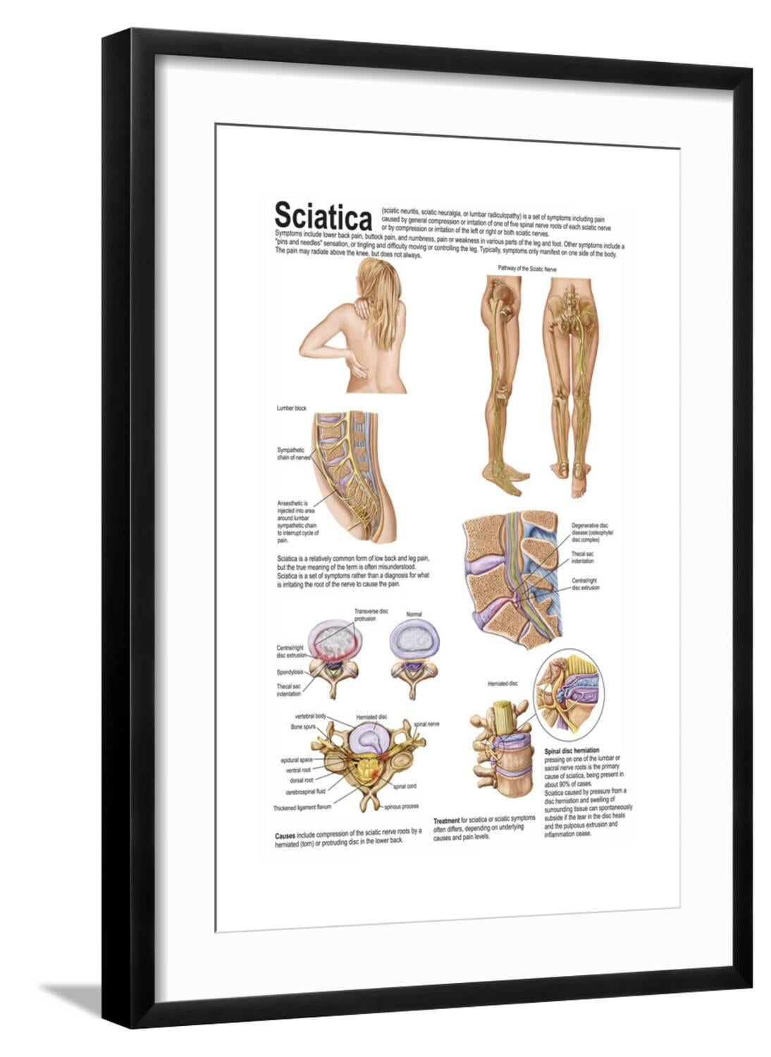 Art.com Medical Chart Showing the Signs and Symptoms of Sciatica Art ...