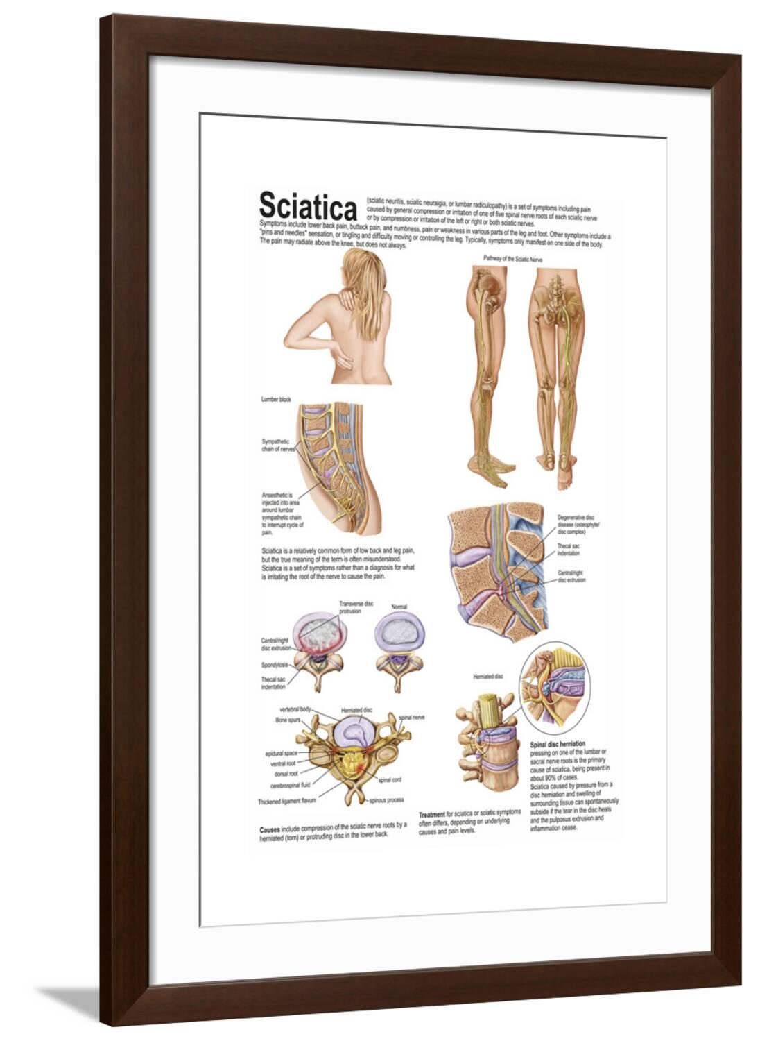 Art.com Medical Chart Showing the Signs and Symptoms of Sciatica Art ...