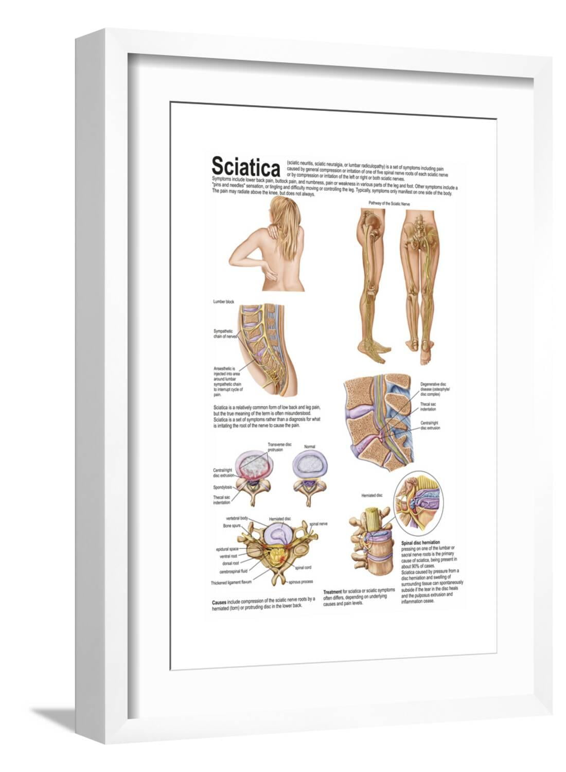 Art.com Medical Chart Showing the Signs and Symptoms of Sciatica Art ...