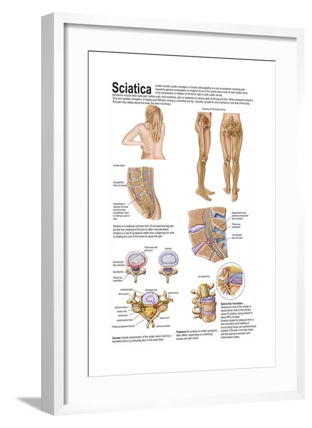 Art.com Medical Chart Showing the Signs and Symptoms of Sciatica Art ...