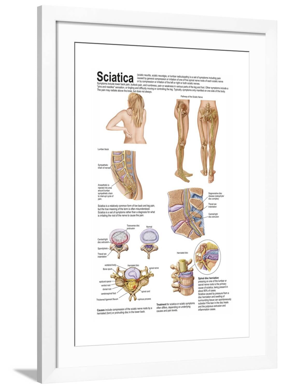 Art.com Medical Chart Showing the Signs and Symptoms of Sciatica Art ...