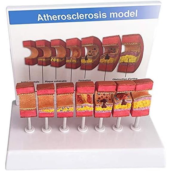 Artery Anatomical Model - Anatomical Vessel Atherosclerosis Thrombus ...