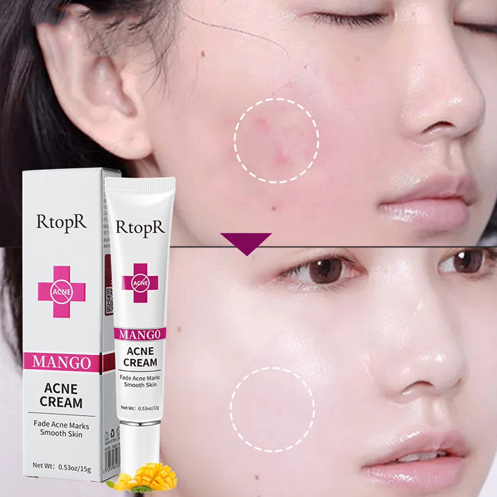 Aursykel Advanced Scar and Mark Removal Cream for Perfect Skin Reduces ...