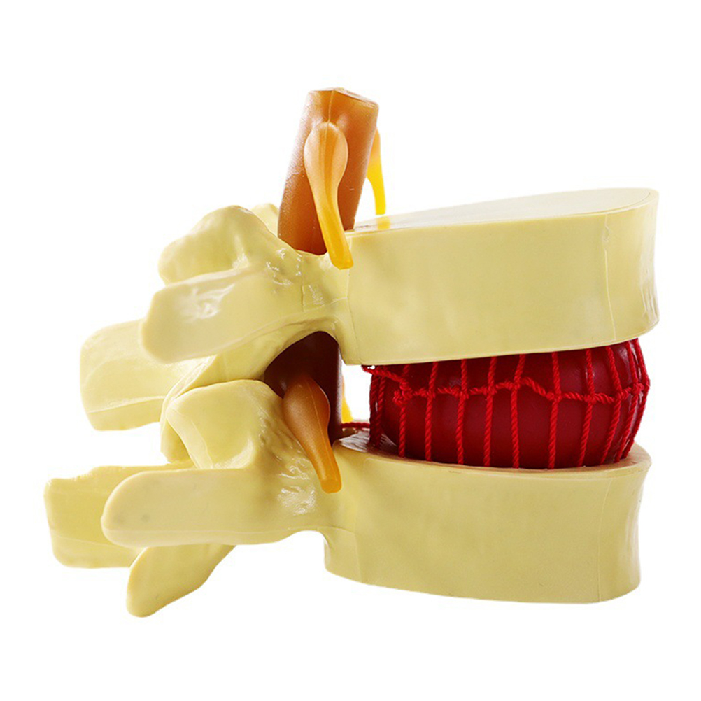 Axio Human Lumbar Disc Herniation Model Lumbar Vertebrae Degenerative ...