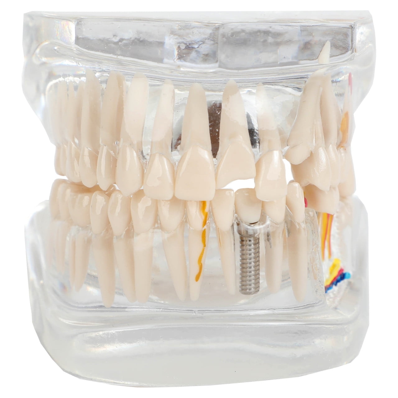 Axis Scientific Transparent Diseased Teeth Anatomy Model - Detailed ...