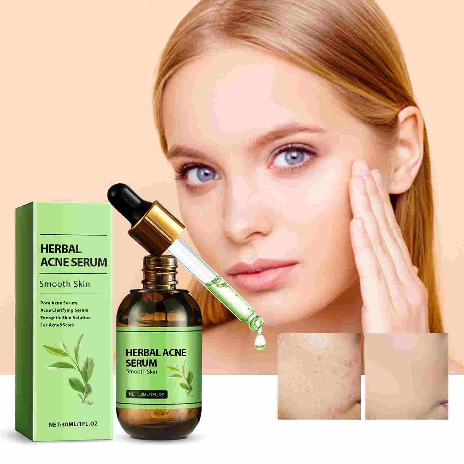 BRISEZZS Pegatinas De Acné, Herbal Acne Serum, Facial Serum, Reduces ...