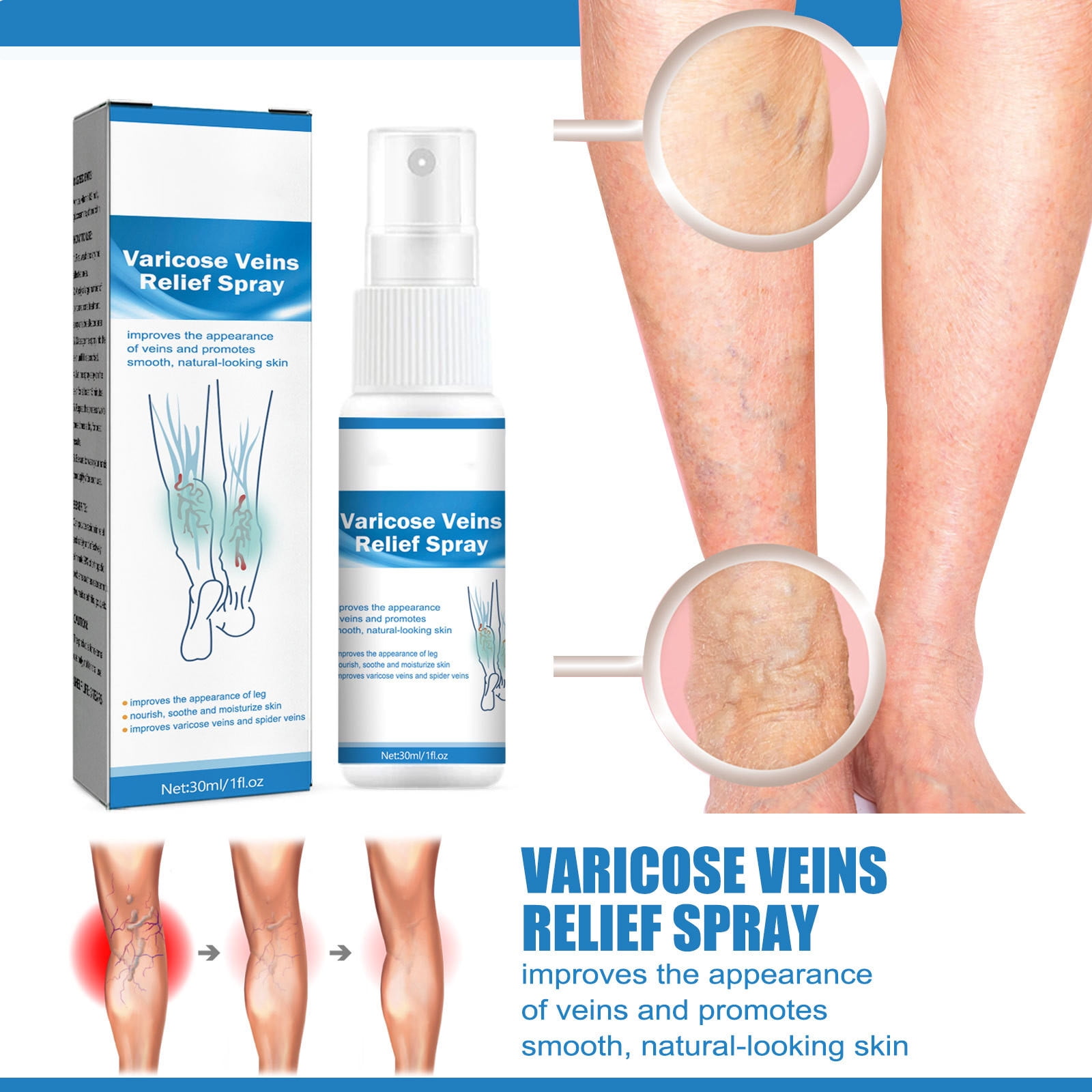 BRISEZZS Price Reduction Spray De VáRices, Spray De Alivio De VáRices ...