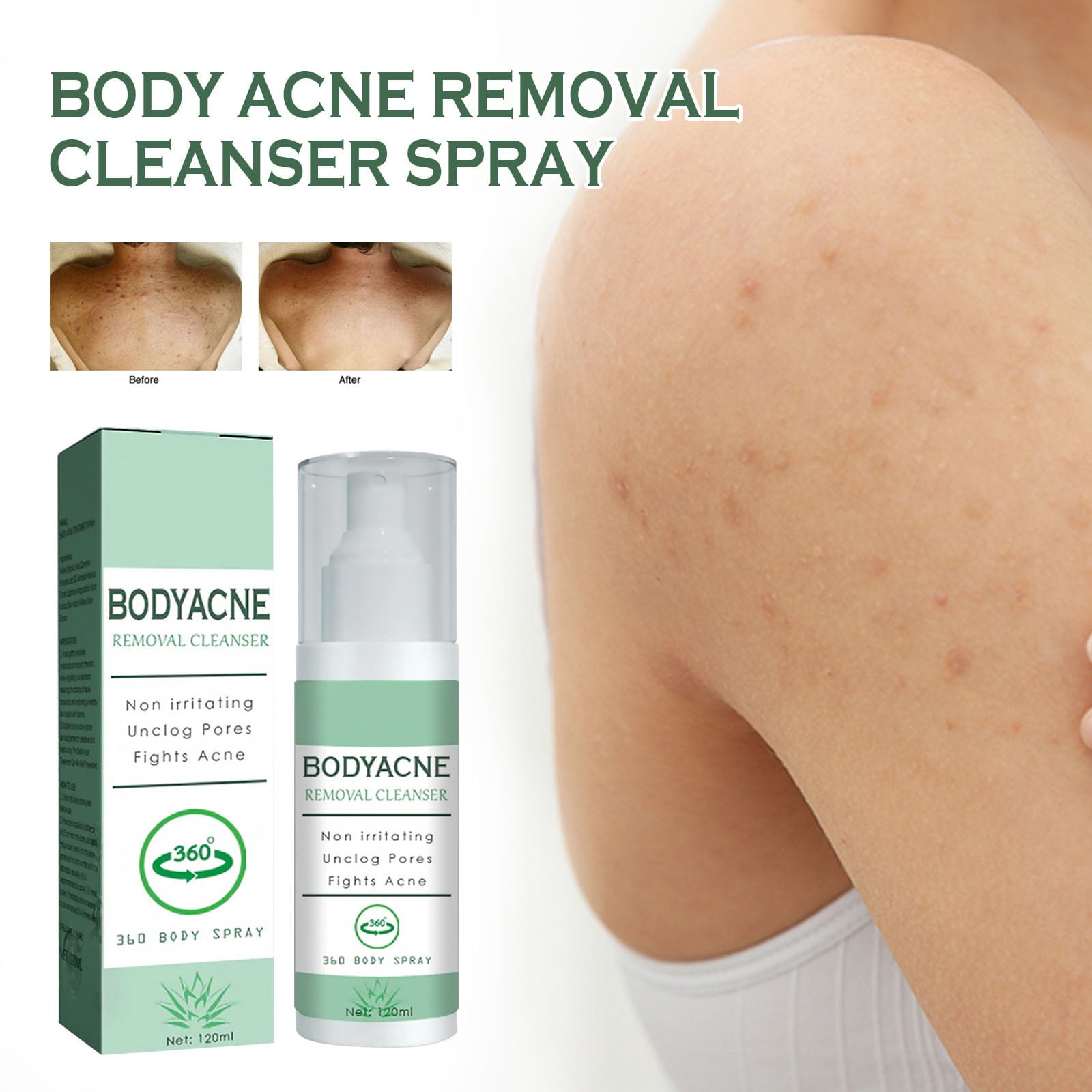 Back Acne Spray,Acne Relief Spray,Back Acne Serum,Body Moisturiser For ...