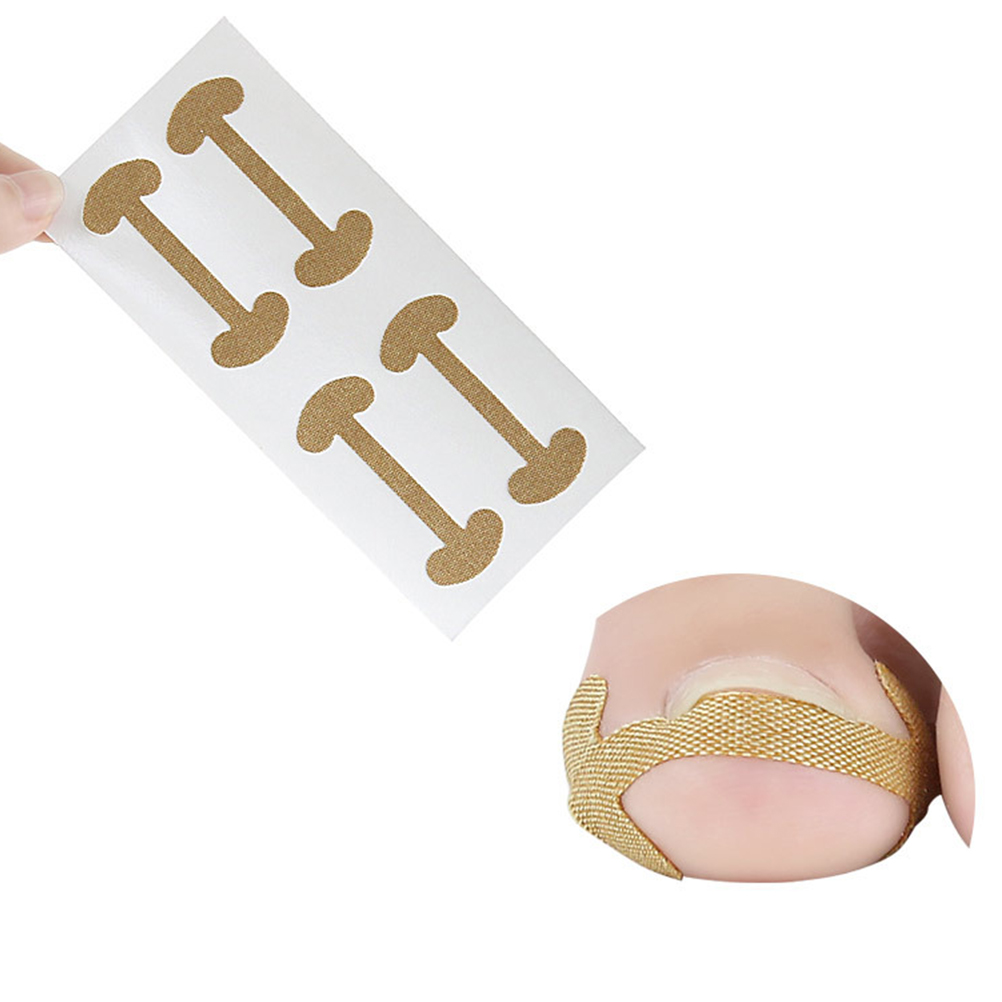 Baluue 10 Sets of Nail Correcting Stickers Ingrowing Toenail Patches ...