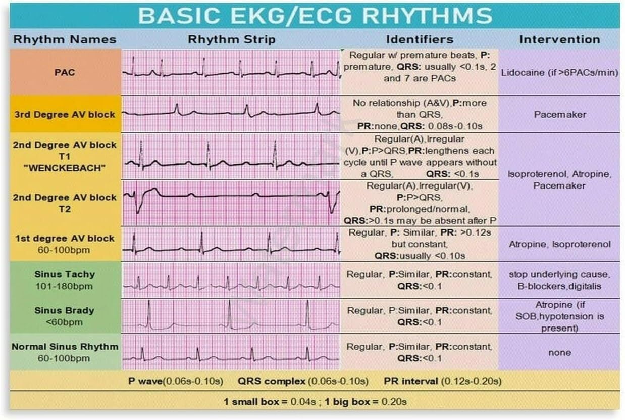 Basic ECG Rhythms Poster, EKG Heart Rhythms, EKG Knowledge (6) Canvas ...