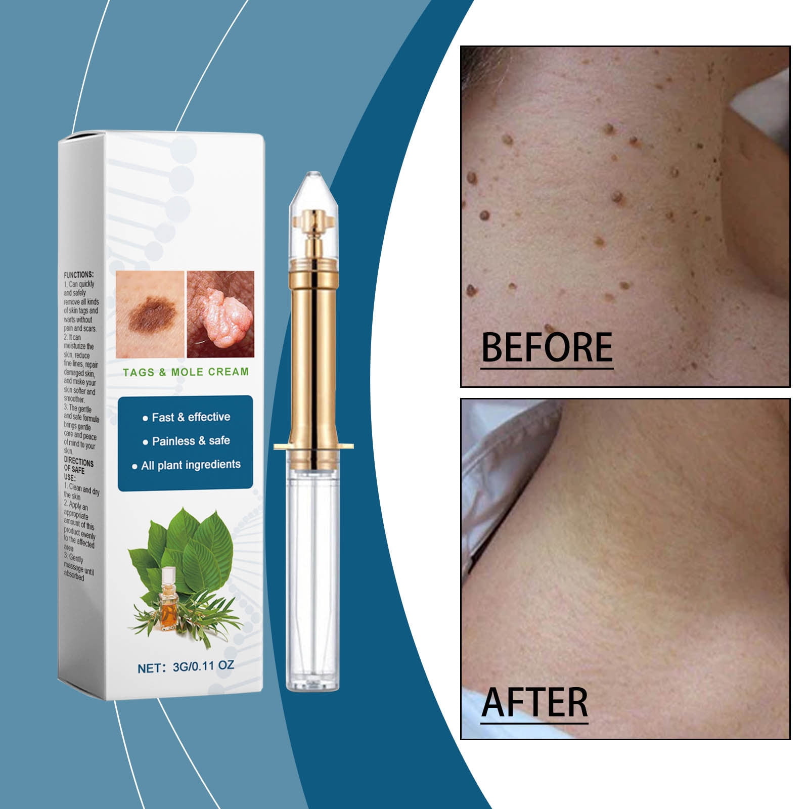 Baycosin Spray Spray For Skin Tags Or Warts The Effectiveness Of Is To ...