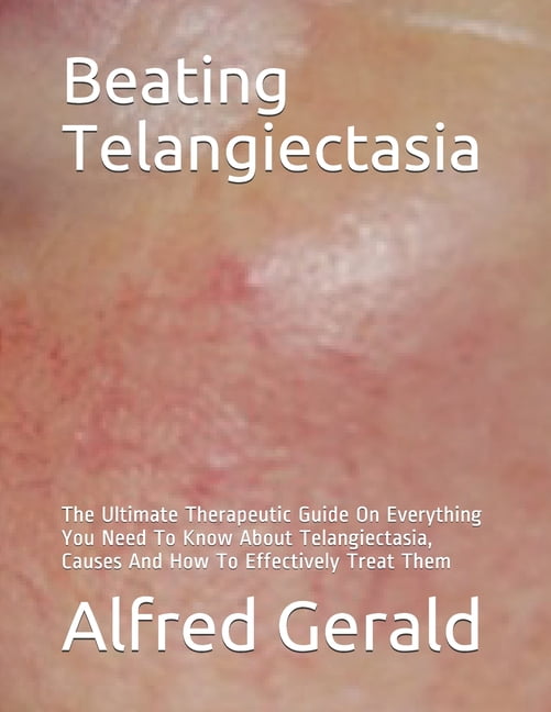 Telangiectasia