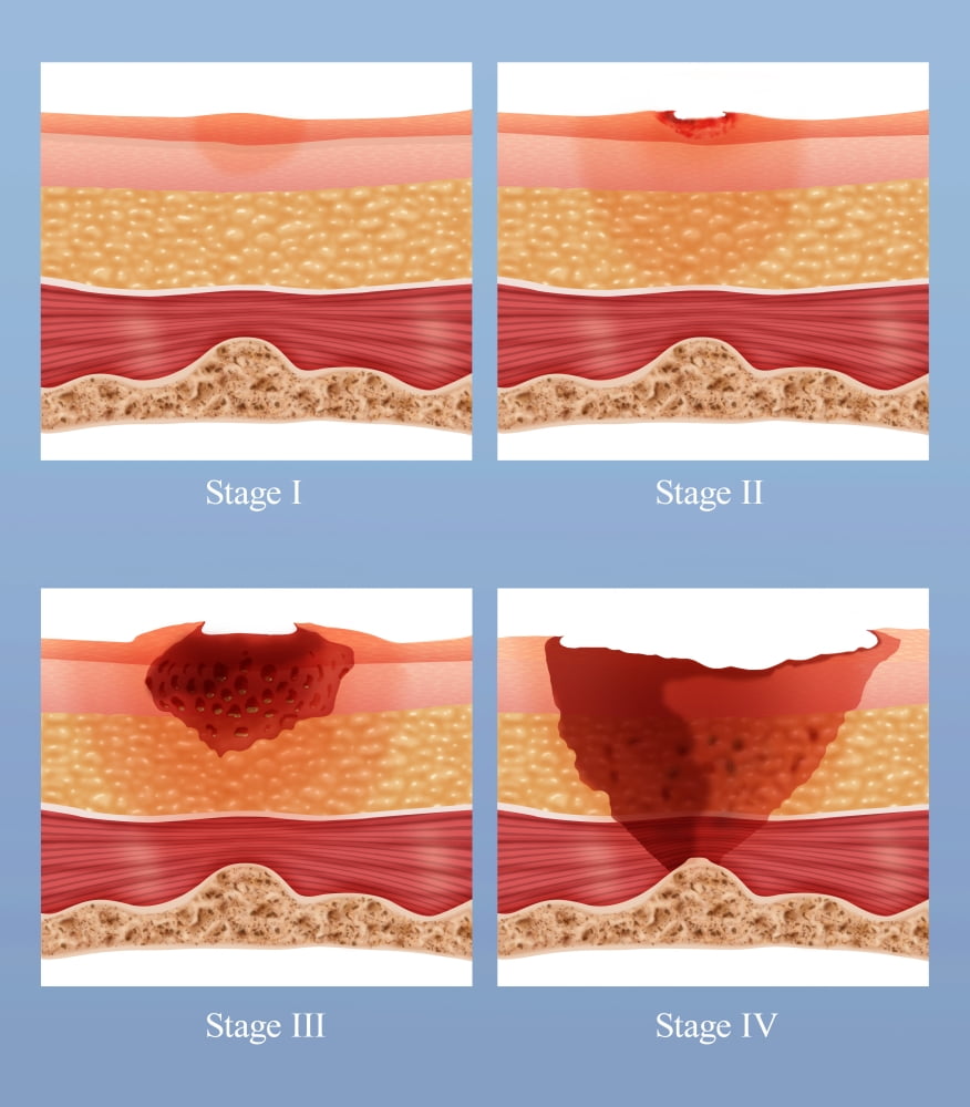 Bed Sores Poster Print by Monica Schroeder/Science Source (18 x 24 ...