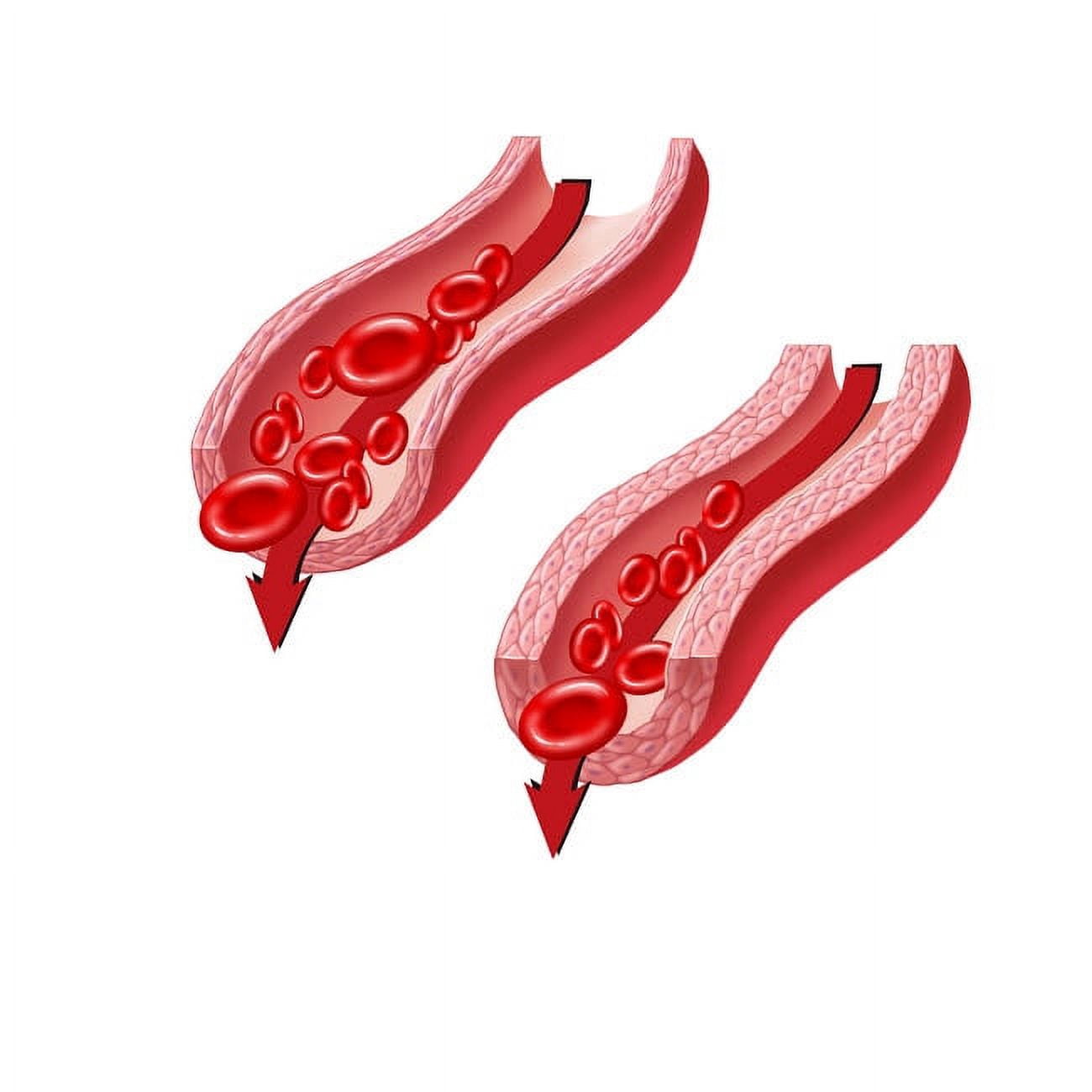 Blood flow through a relaxed artery verus an artery in spasm Poster ...