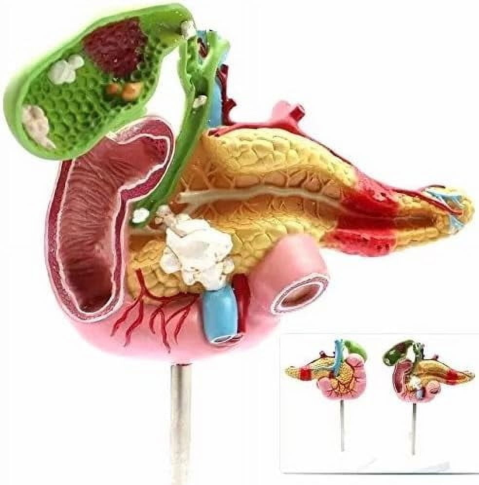 BoNew Human Duodenum Gall Bladder Disease Anatomy Medical Model Life ...