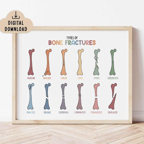 Bone Fractures Poster, Broken Bone Illustration Future Doctor Printable ...