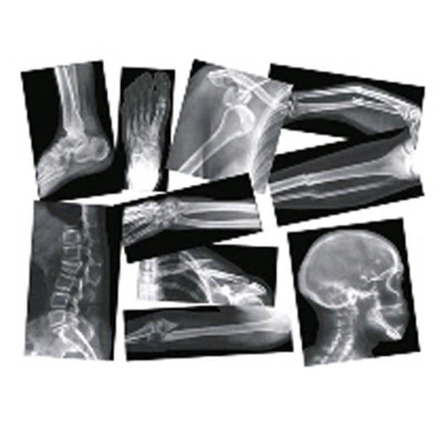 Broken Bone Compound Fracture X-Rays - Walmart.com