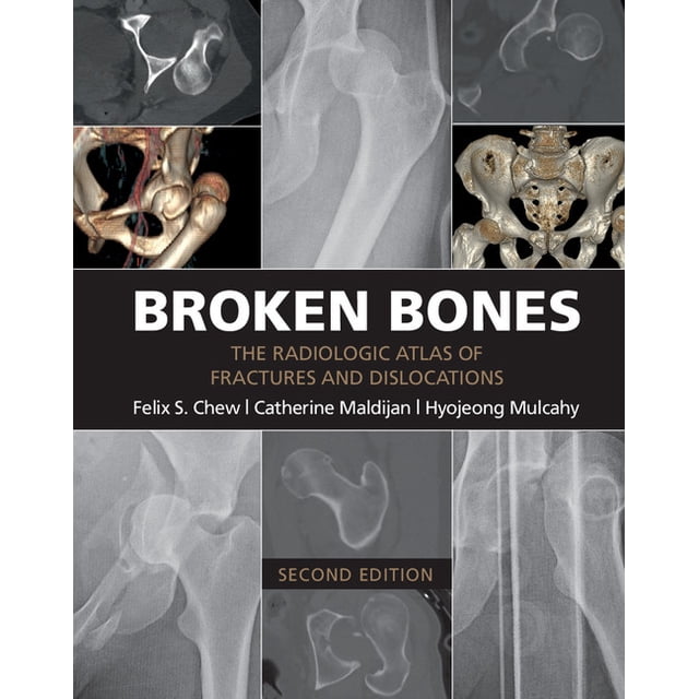 Broken Bones: The Radiologic Atlas of Fractures and Dislocations ...