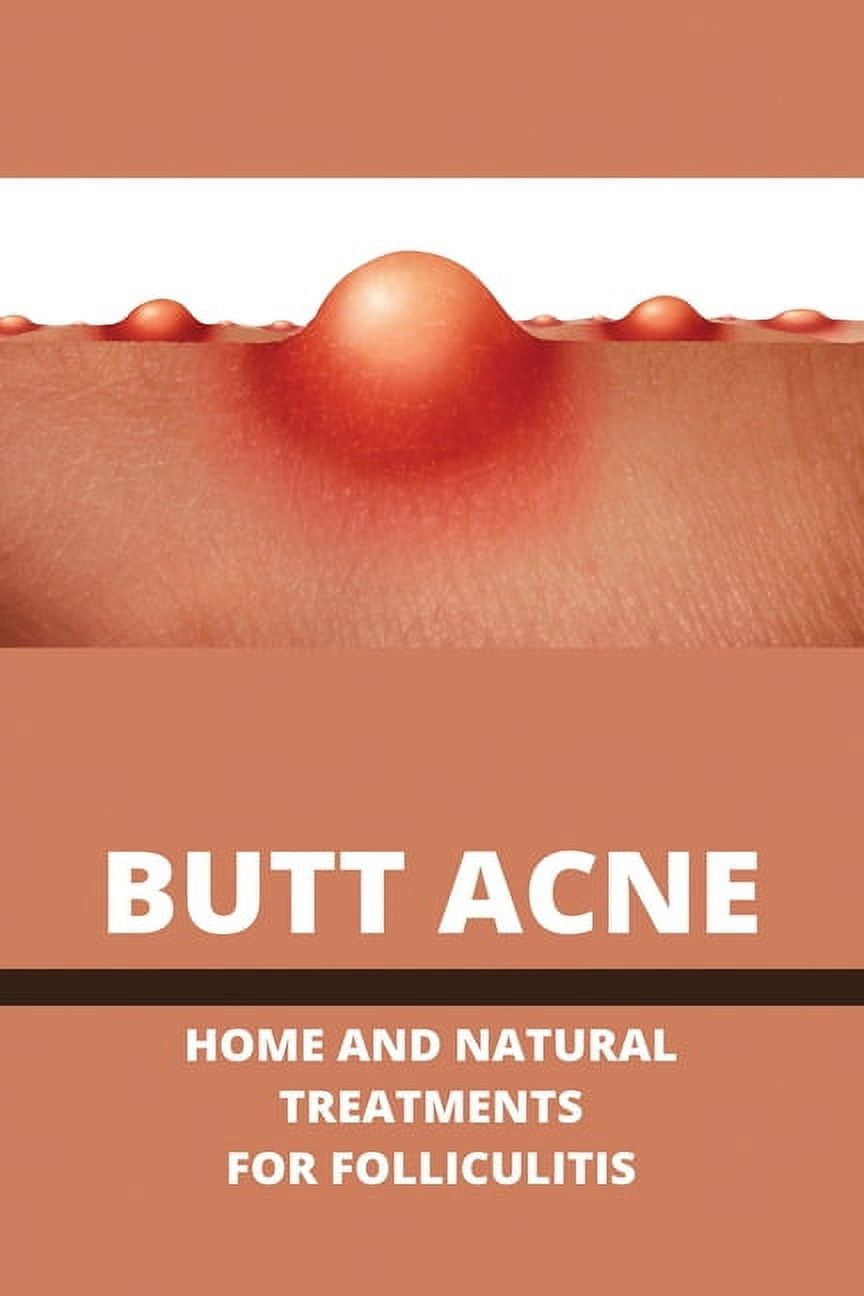 Butt Acne: Home and Natural Treatments for Folliculitis (Paperback ...