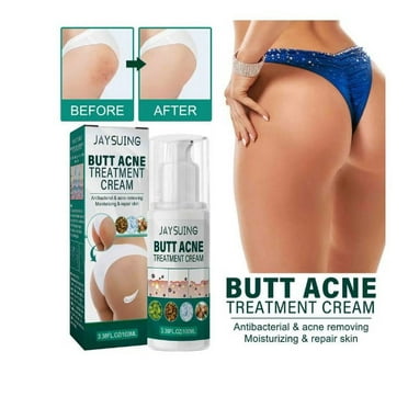 DLC De La Cruz Acne Treatment Ointment with 10% Sulfur, Maximum Strength for Pimples, Blackheads ...