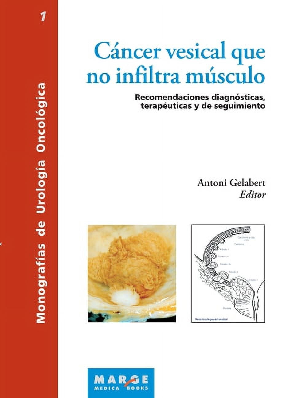 Cáncer vesical que no infiltra músculo: Recomendaciones diagnósticas ...