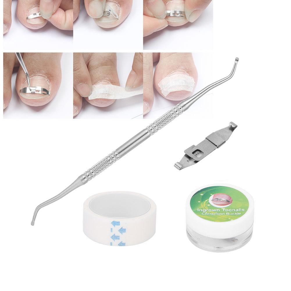 CHICIRIS 3pcs Ingrown Toenail Corrector Paronychia Treatment Nail ...