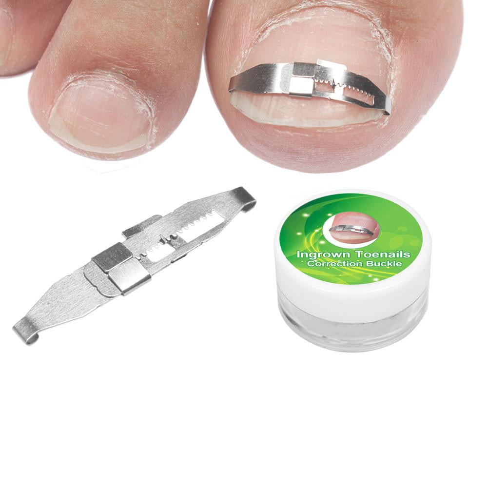 CHICIRIS Stainless Steel Ingrown Toenail Corrector Paronychia Treatment ...