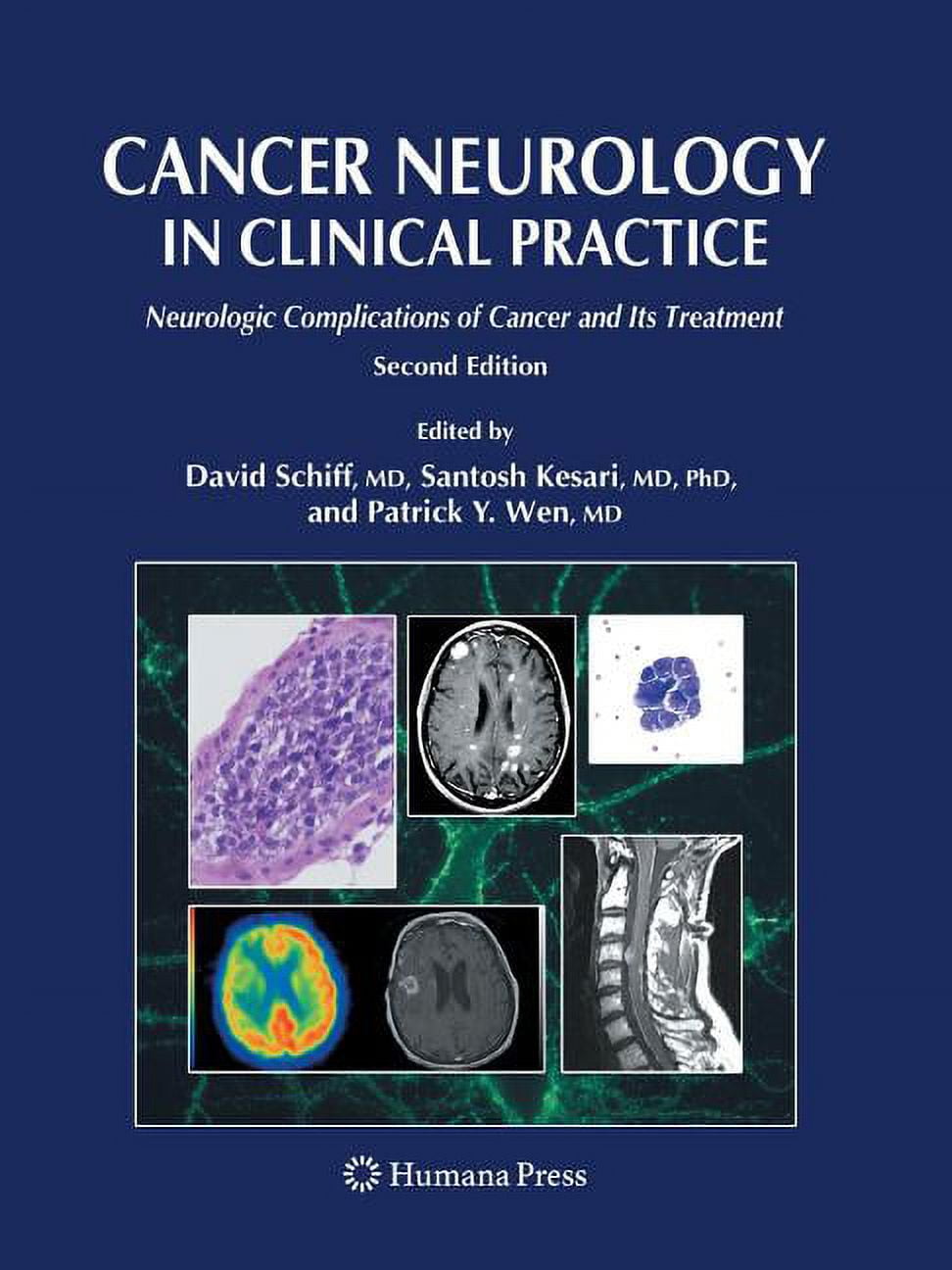 Cancer Neurology in Clinical Practice: Neurologic Complications of ...