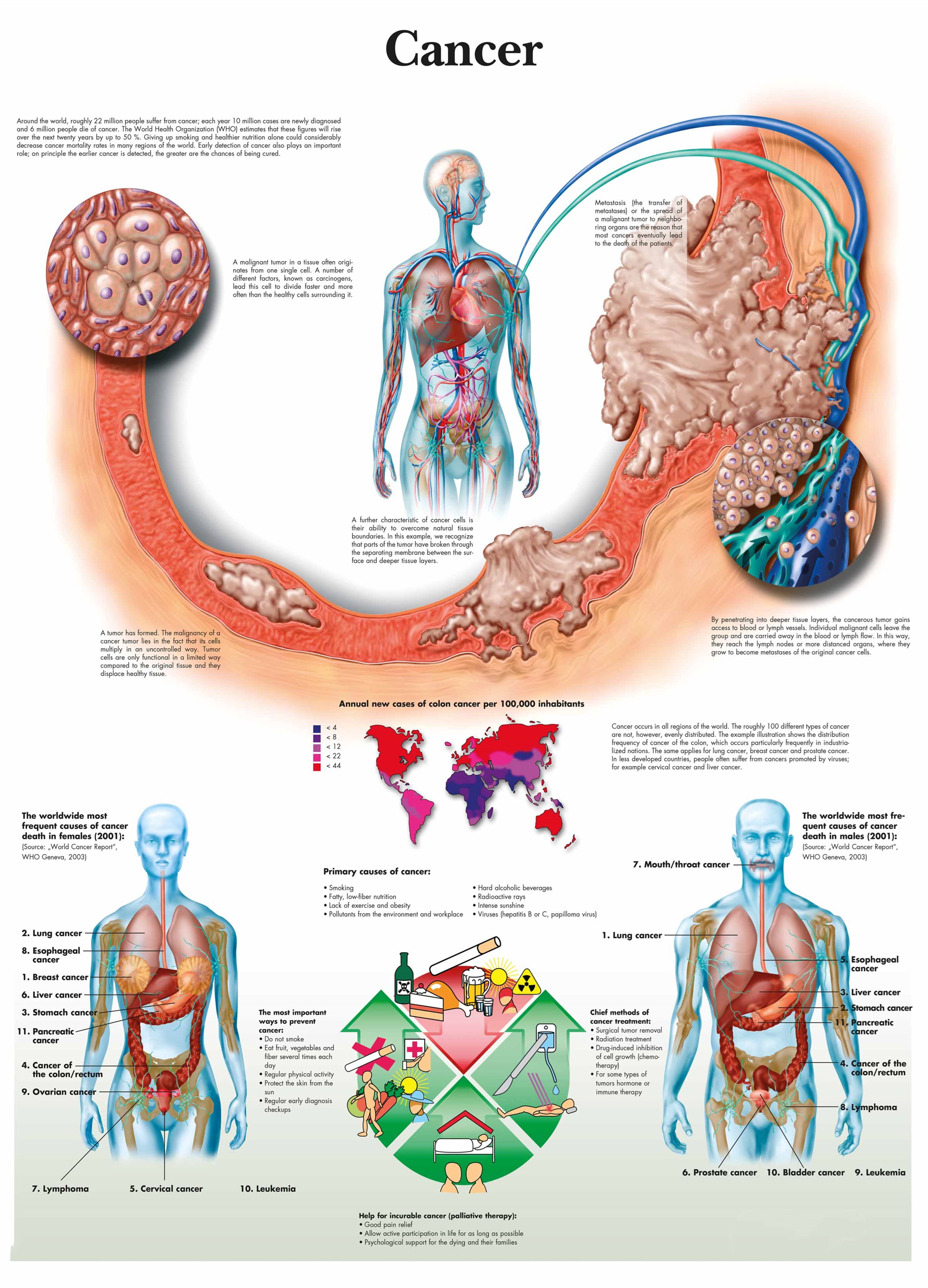Cancer Wall Art Posters Canvas Print Artwork Wall Chart Human Anatomy ...