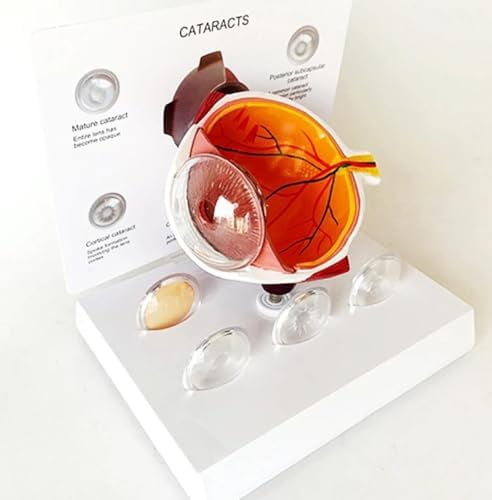 Cataract Eye Model, Eye Anatomy Cataract Eye Physician Research Model ...
