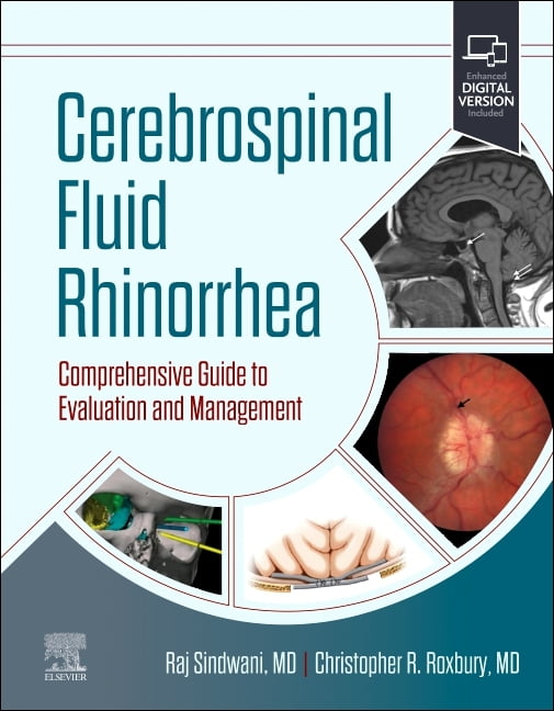 Cerebrospinal Fluid Rhinorrhea: Comprehensive Guide to Evaluation and ...