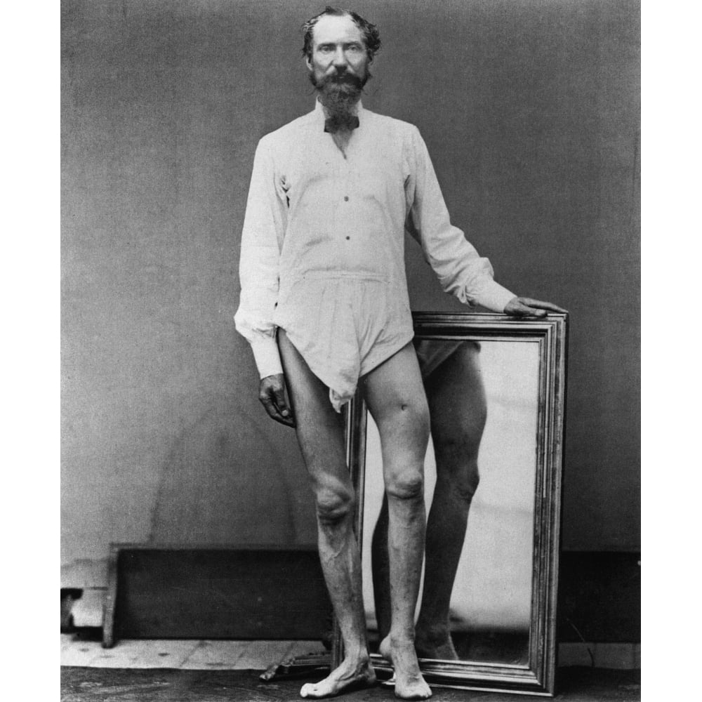 Civil War Gunshot Wound. Nan American Civil War Veteran With A Gunshot ...