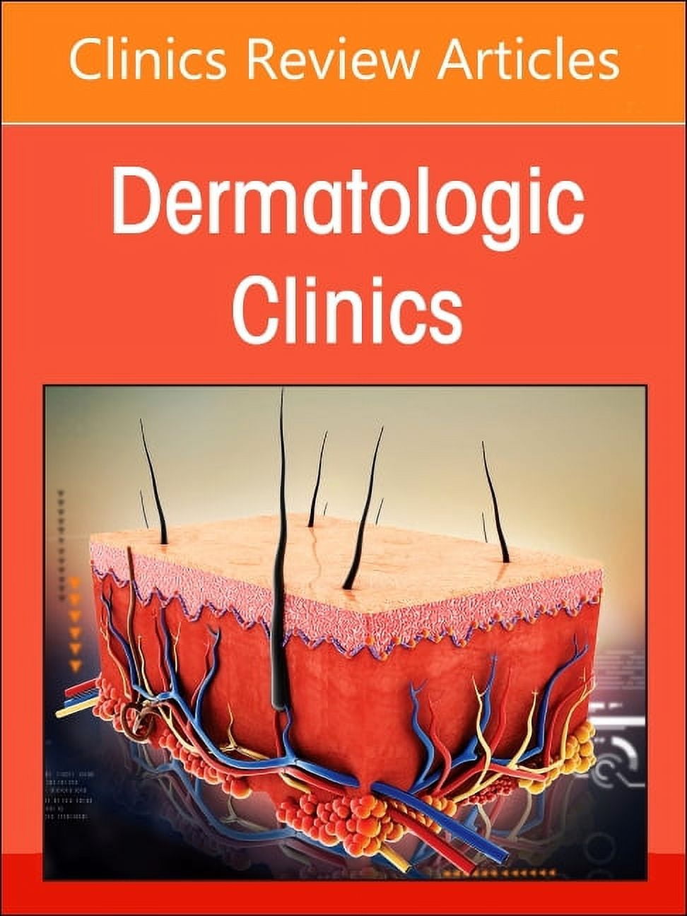Clinics: Dermatology Hidradenitis Suppurativa, an Issue of Dermatologic ...