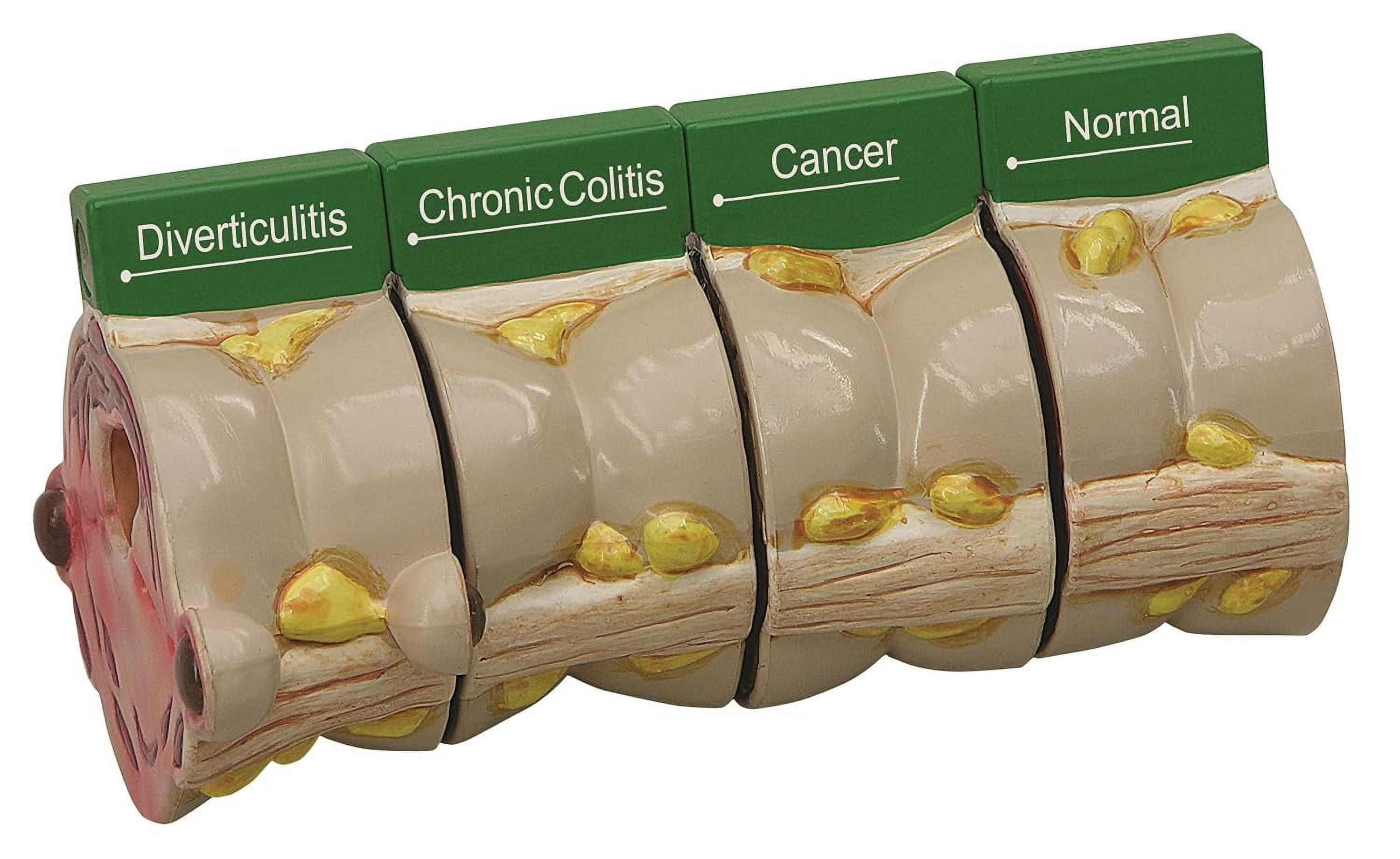Colon Model, of a Colon with Pathologies for Human Anatomy and ...