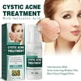 Cystic Hormonal And Severe Acne Cream For Teens And Adults Acne With