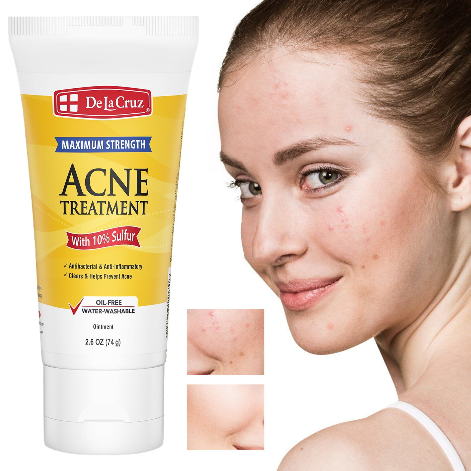 De La Cruz Sulfur Acne Treatment-Acne Treatment For Face,Sulfur Mask ...