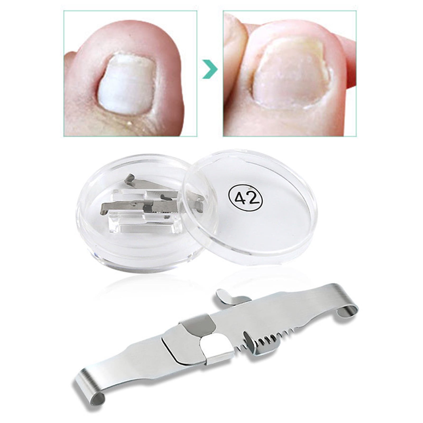 Demete Professional Lightweight Ingrown Toenail Treatment Stainless ...