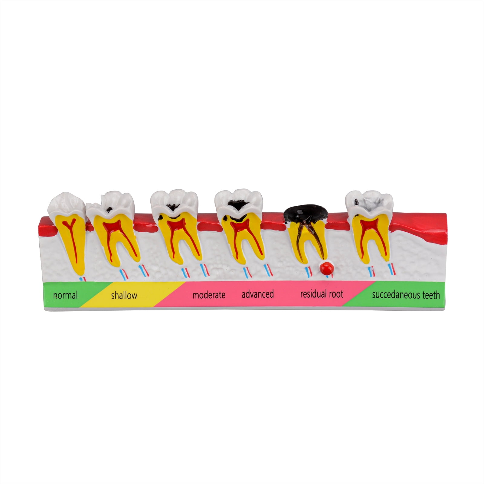 Periodontal Disease Treatment Buy Pevor New Dental Teeth Model Tooth ...