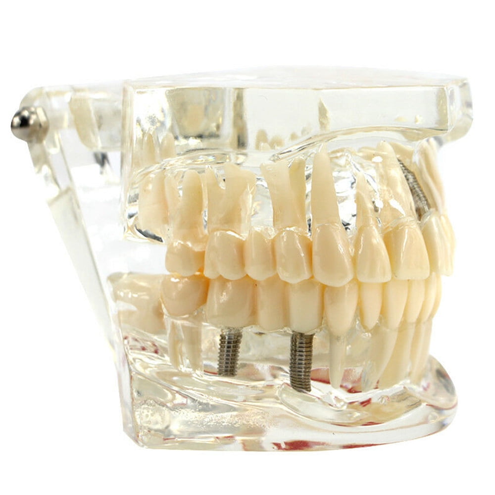 Dental Implant Disease Teeth Model With Restoration Bridge Tooth Dental ...