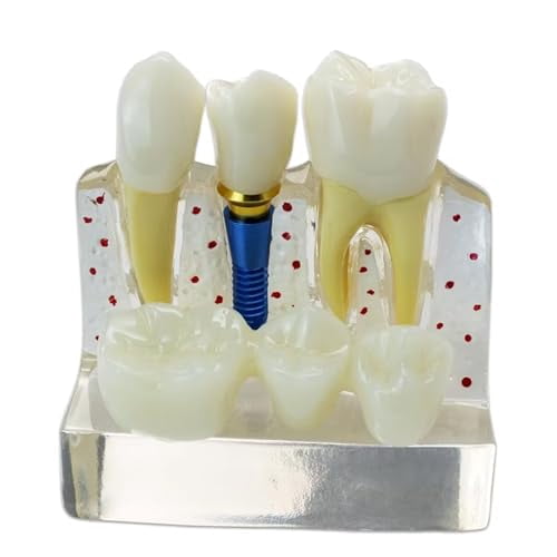 Dental Implant Model, 4 Times Transparent Teeth Model with Analysis ...